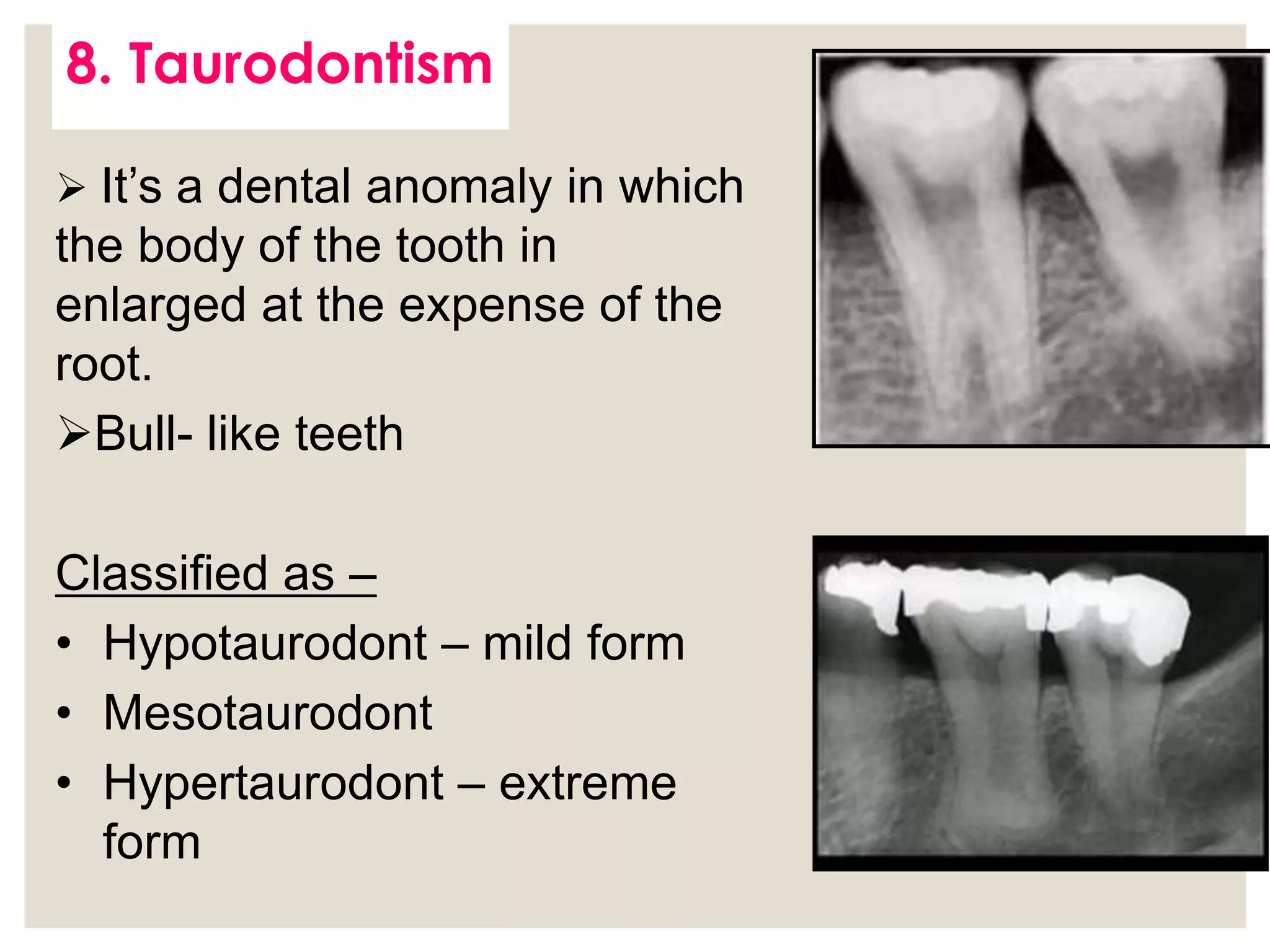 Developmental disturbances shape, size and number of the teeth | PPTX