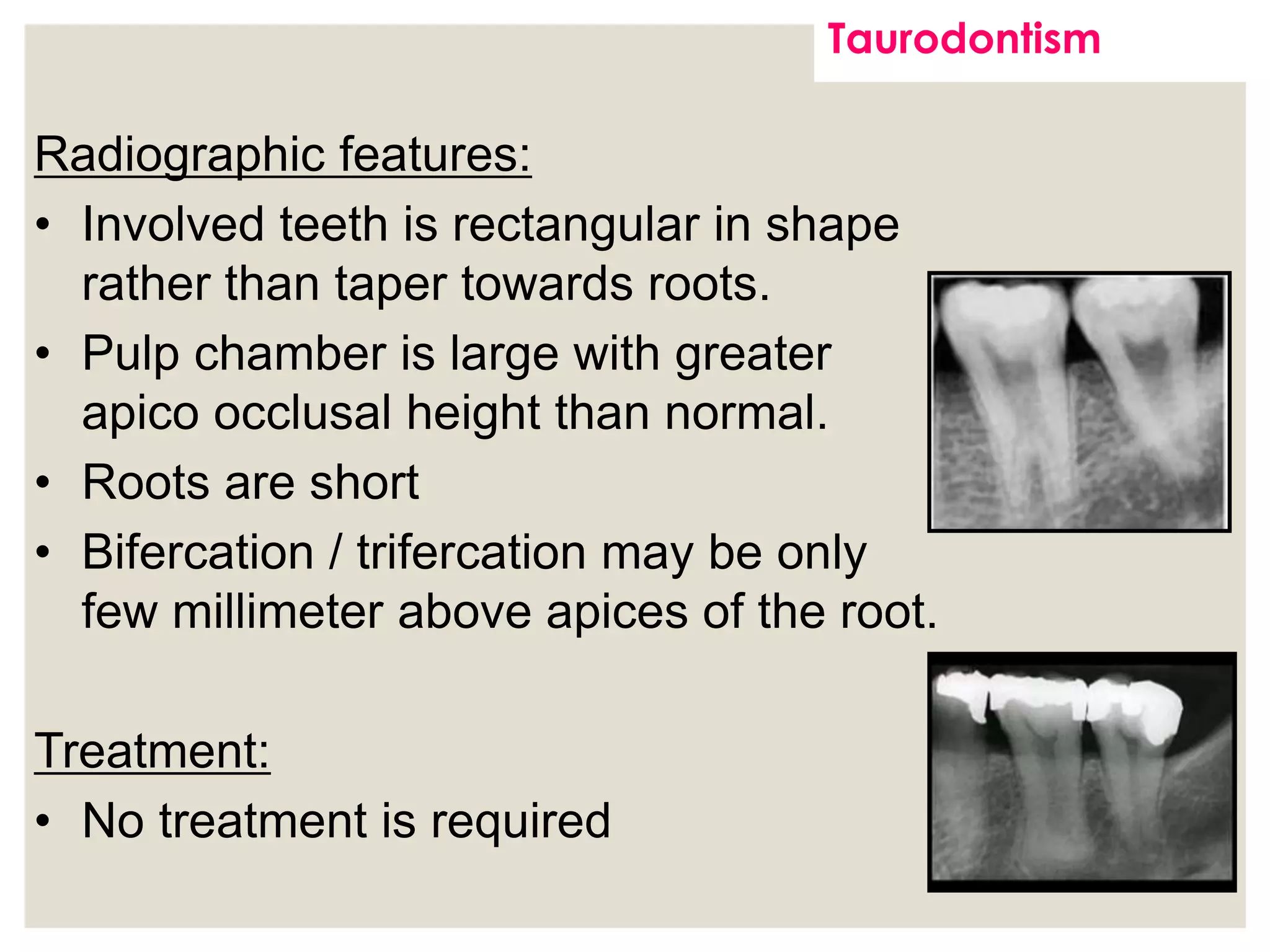 Developmental disturbances shape, size and number of the teeth | PPTX