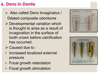 Developmental disturbances shape, size and number of the teeth | PPTX