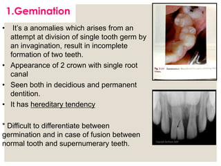 Germination Teeth