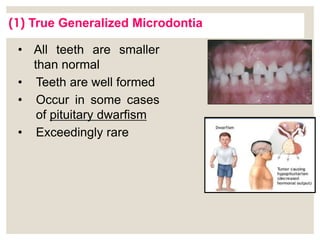 True Generalized Microdontia