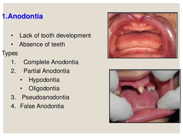 Developmental disturbances shape, size and number of the teeth