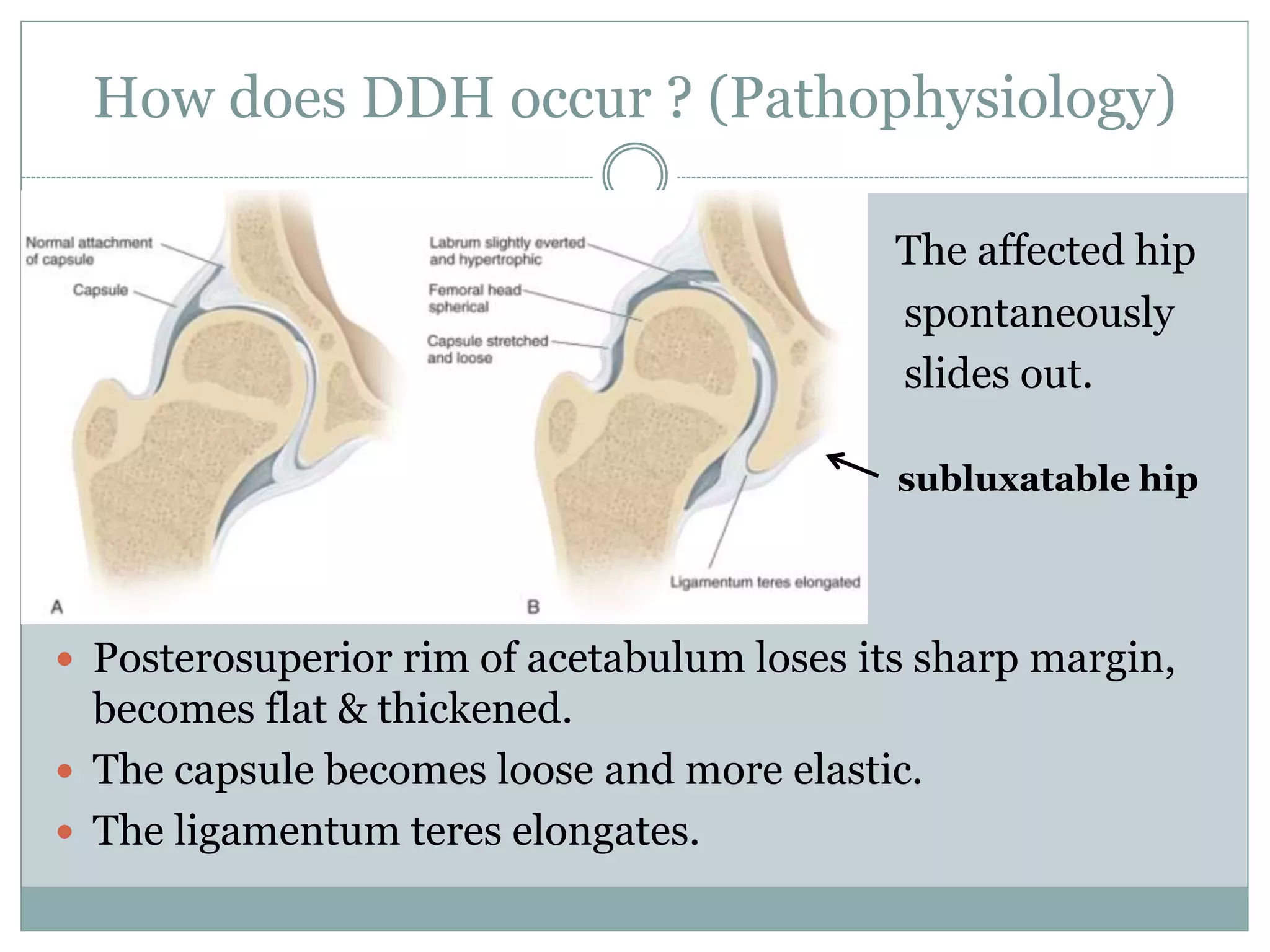 Developmental dyspalsia of hip | PPTX
