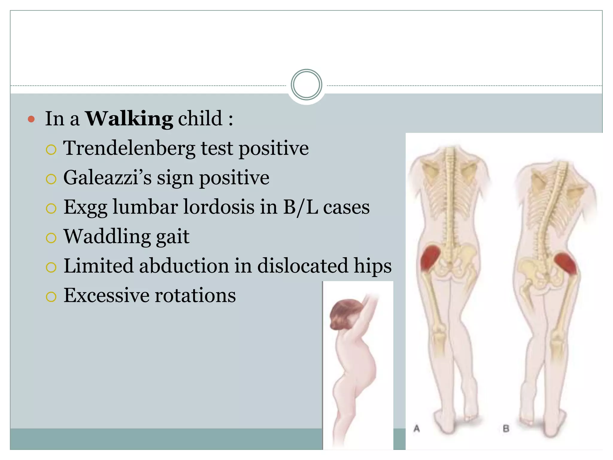 Developmental dyspalsia of hip | PPTX