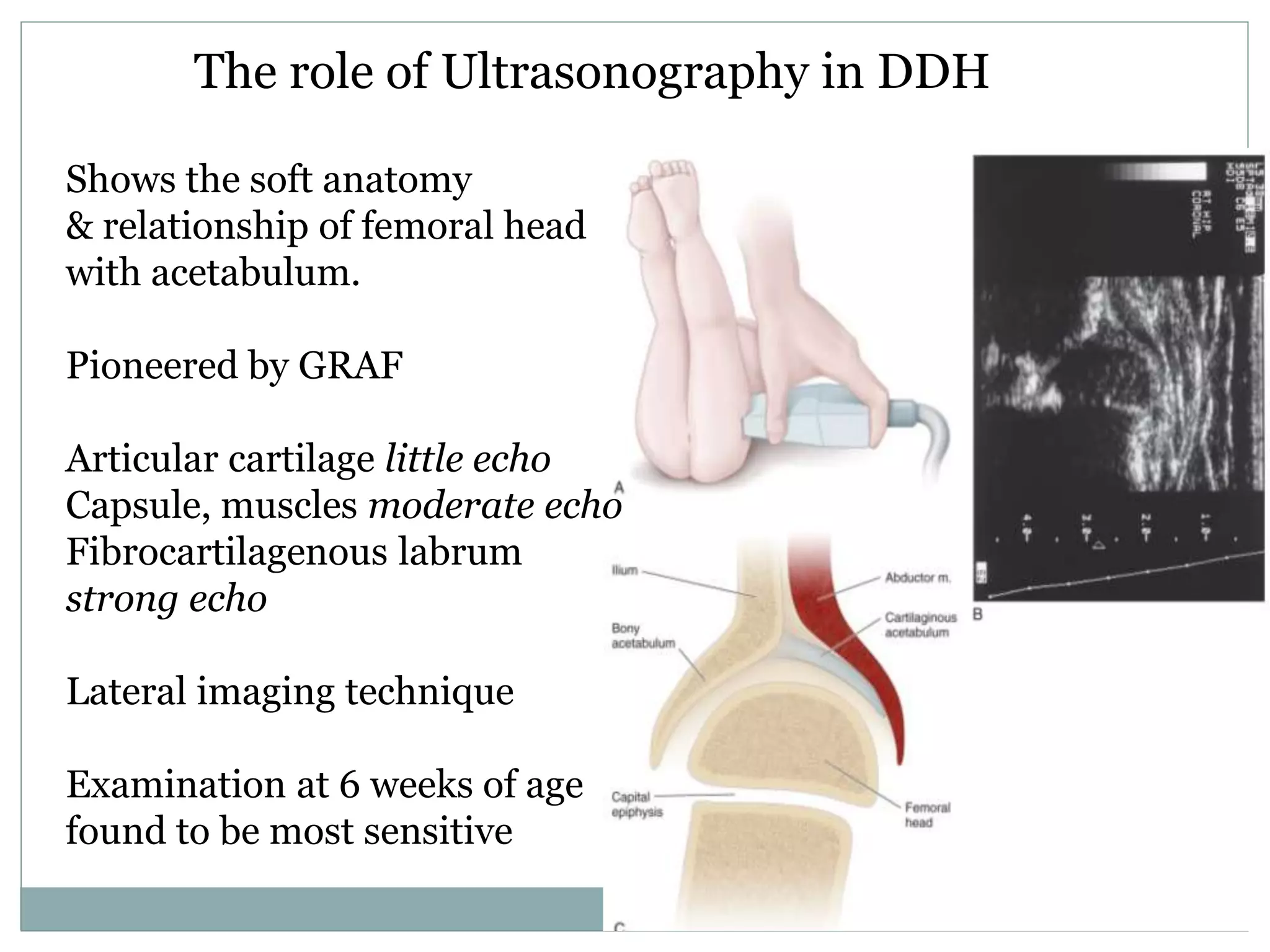 Developmental dyspalsia of hip | PPTX