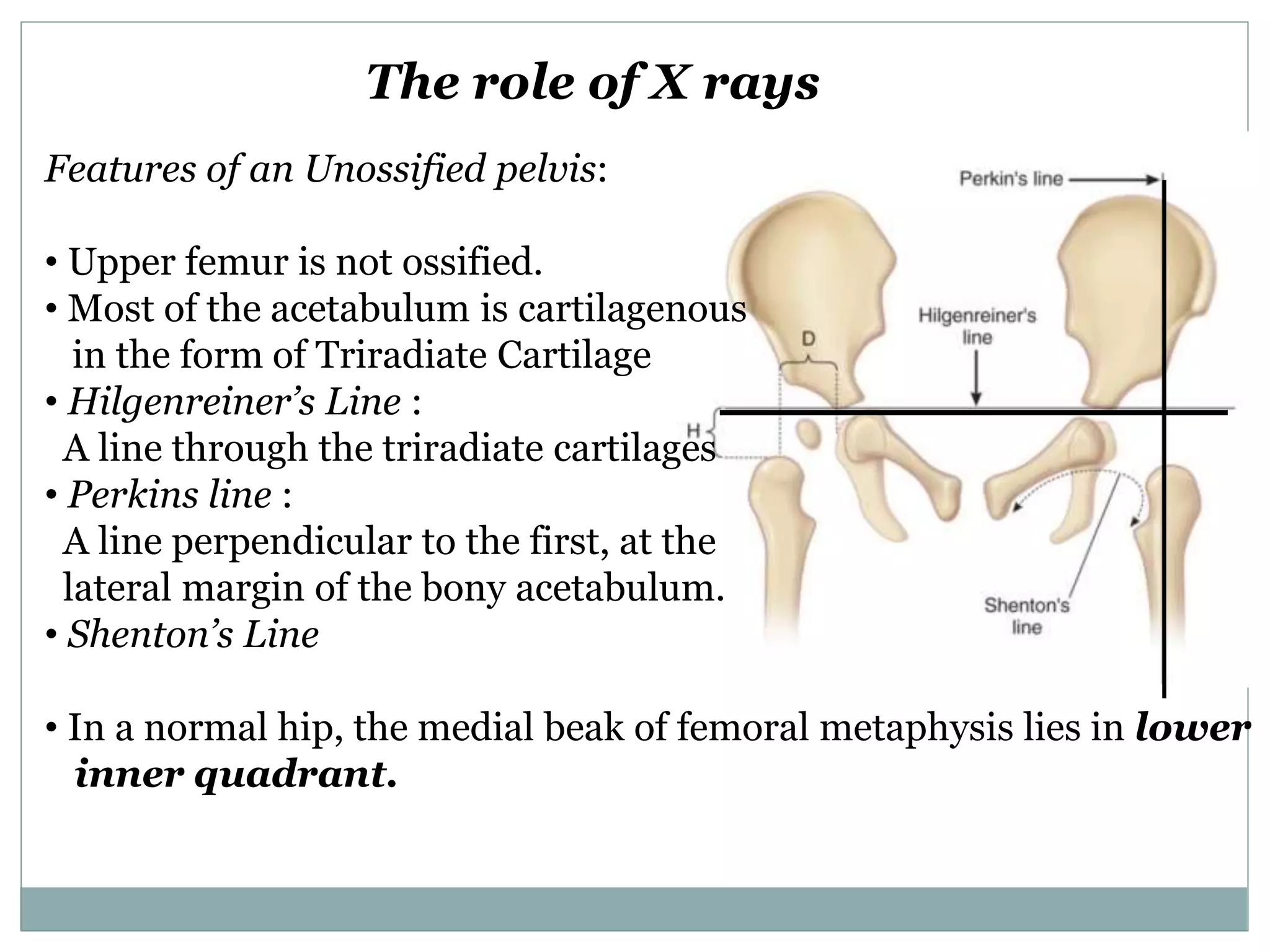 Developmental dyspalsia of hip | PPTX