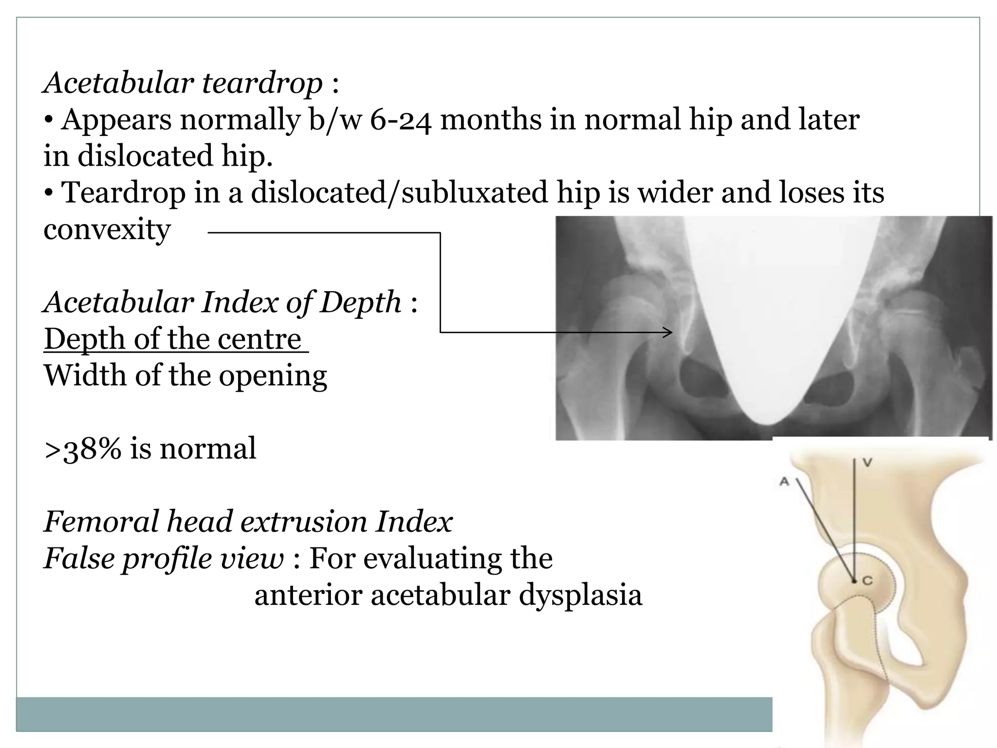 Developmental dyspalsia of hip | PPTX