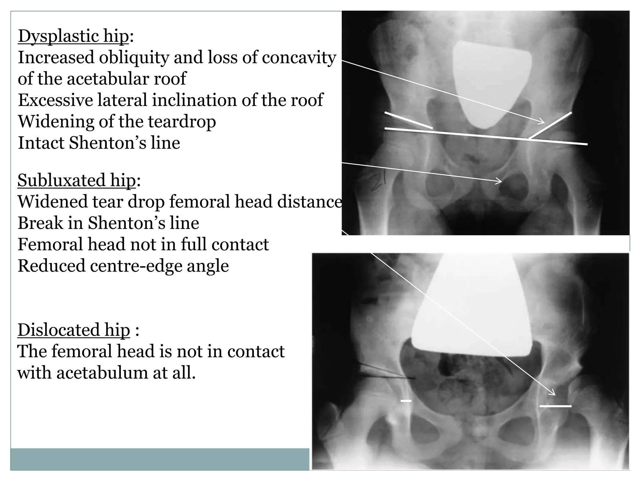 Developmental dyspalsia of hip | PPTX