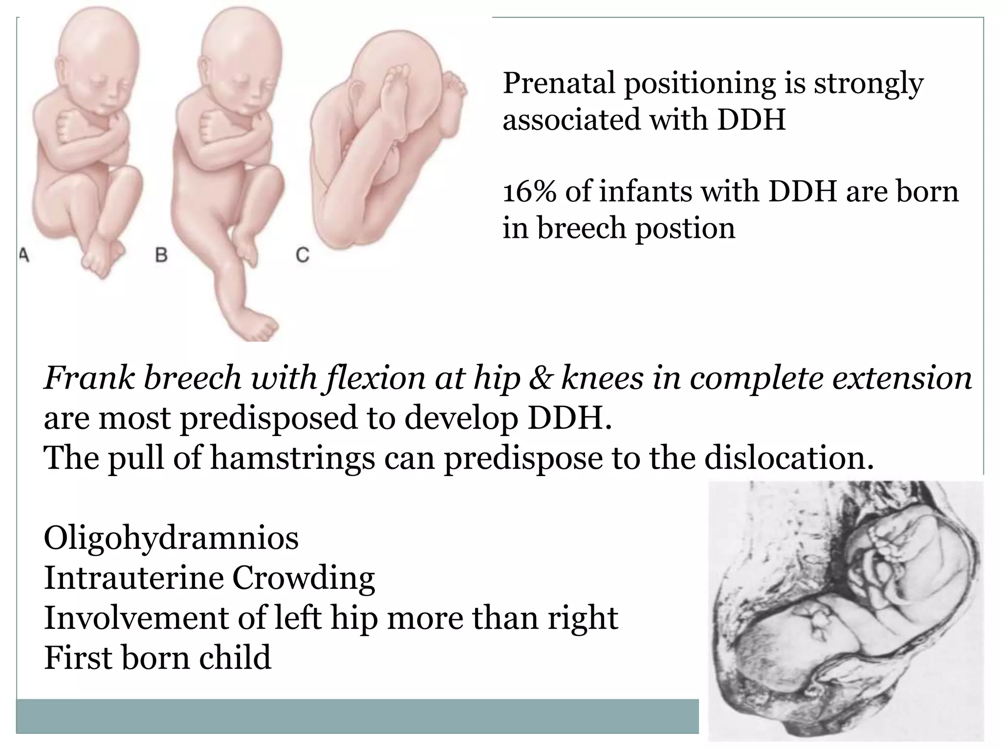 Developmental dyspalsia of hip | PPTX