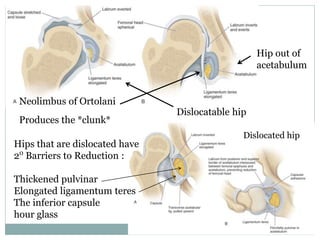Developmental dyspalsia of hip | PPTX