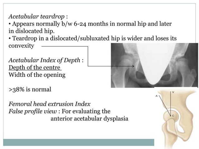 Developmental dyspalsia of hip | PPT