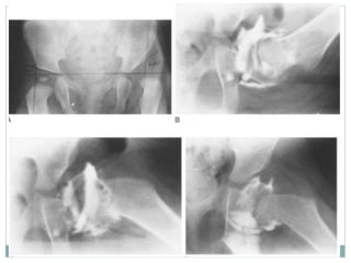 Developmental dyspalsia of hip | PPTX