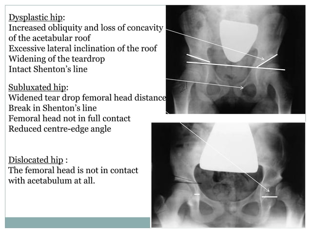 Developmental dyspalsia of hip | PPT