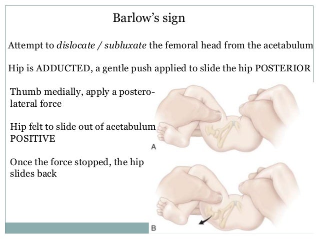 Developmental dyspalsia of hip