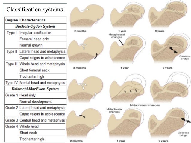 Developmental dyspalsia of hip