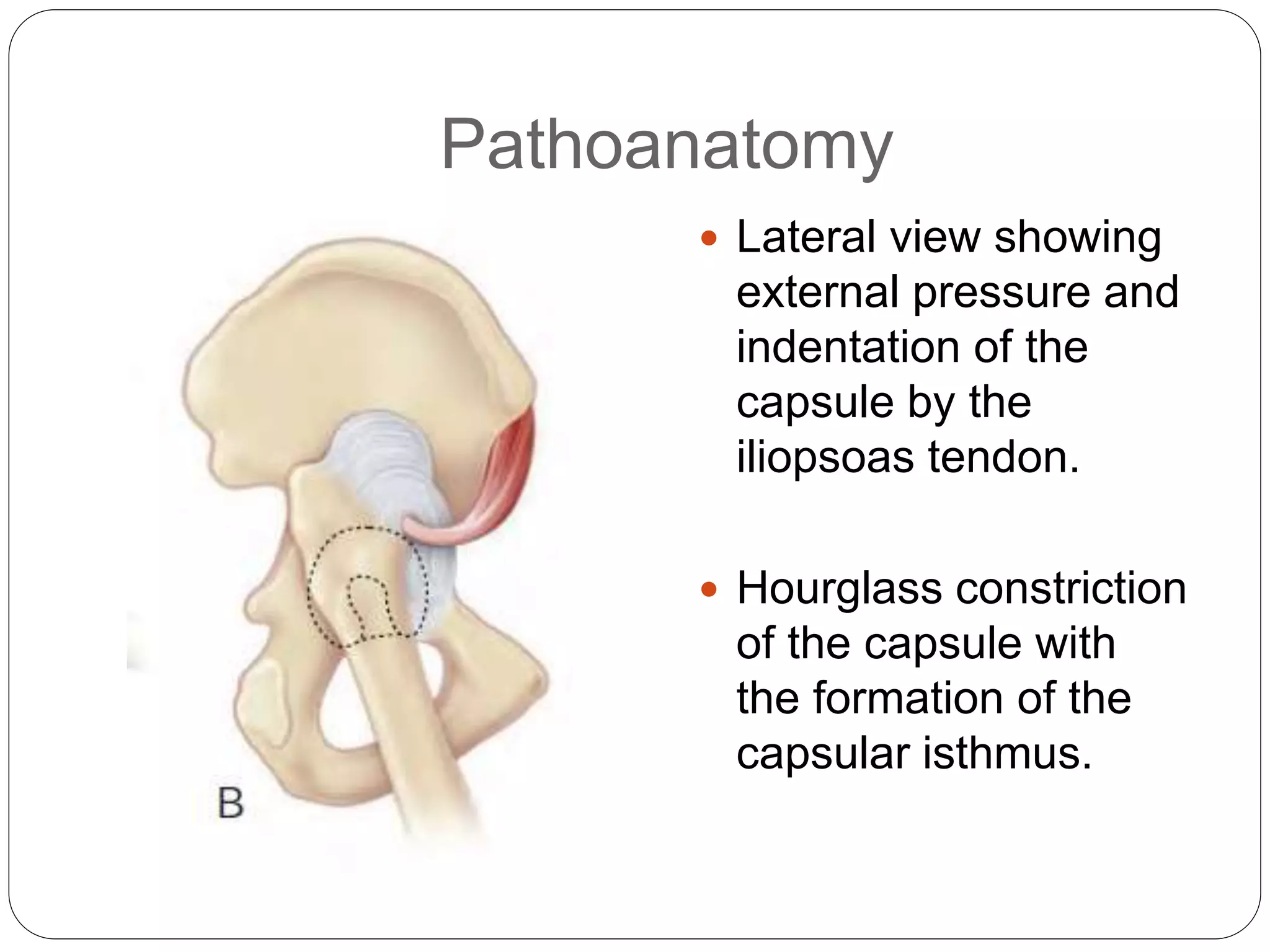 Developmental dysplasia hip | PPTX