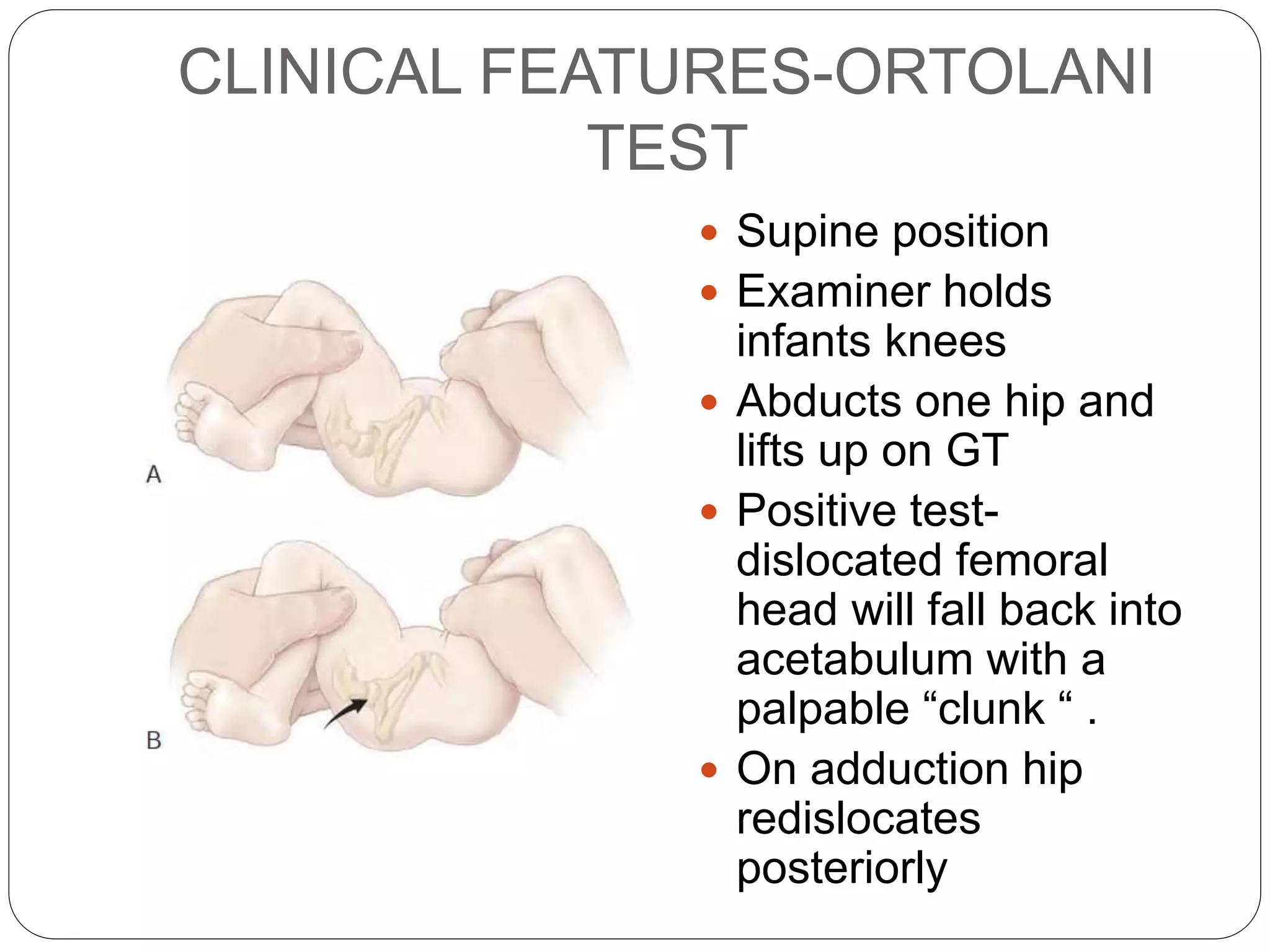 Developmental dysplasia hip | PPTX