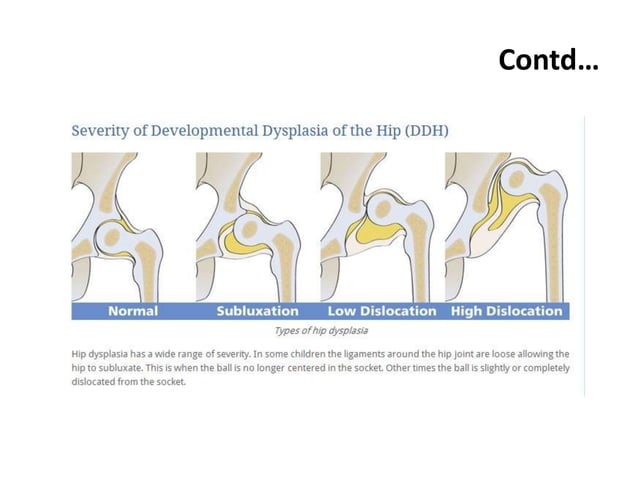 Developmental dysplasia hip | PPTX