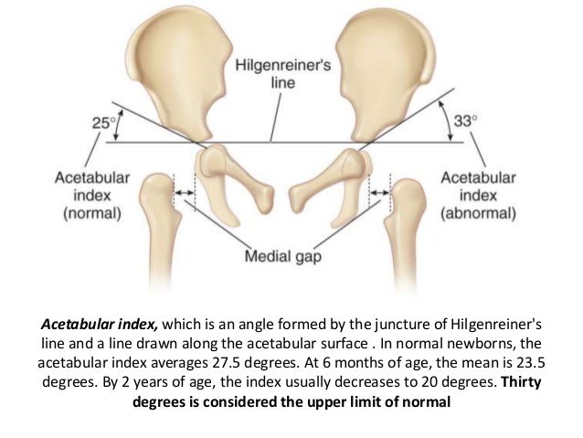 Developmental dysplasia of hip