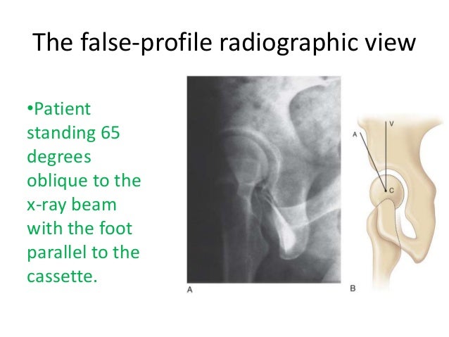 Developmental dysplasia of hip