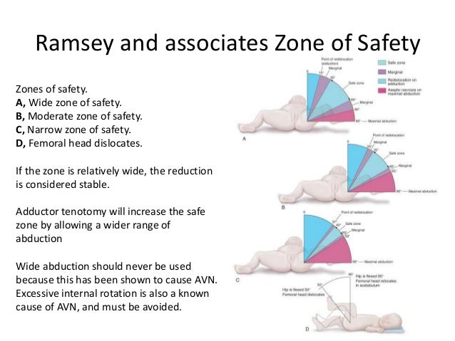 Developmental dysplasia of hip