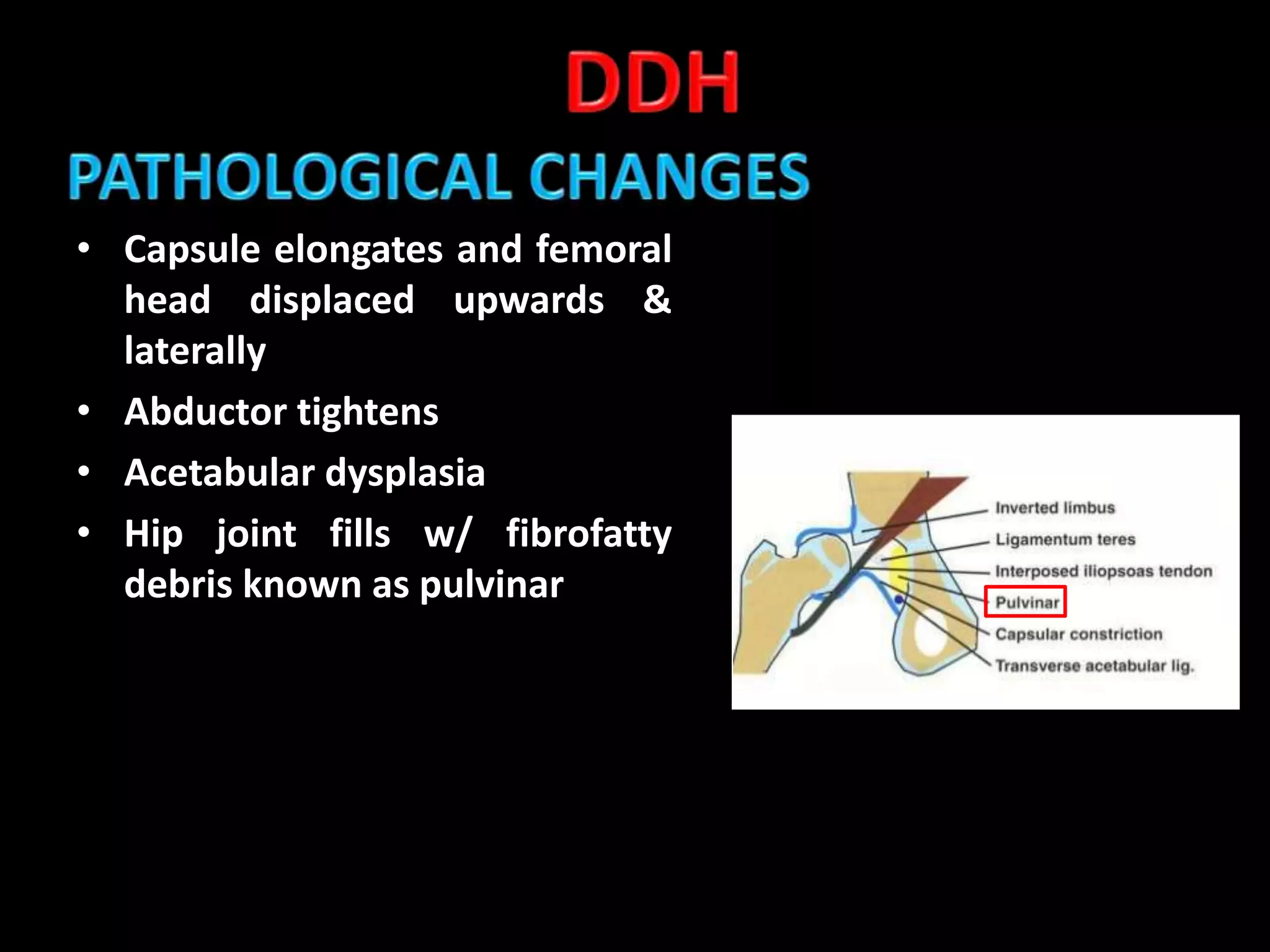 Developmental dysplasia of hip | PPTX