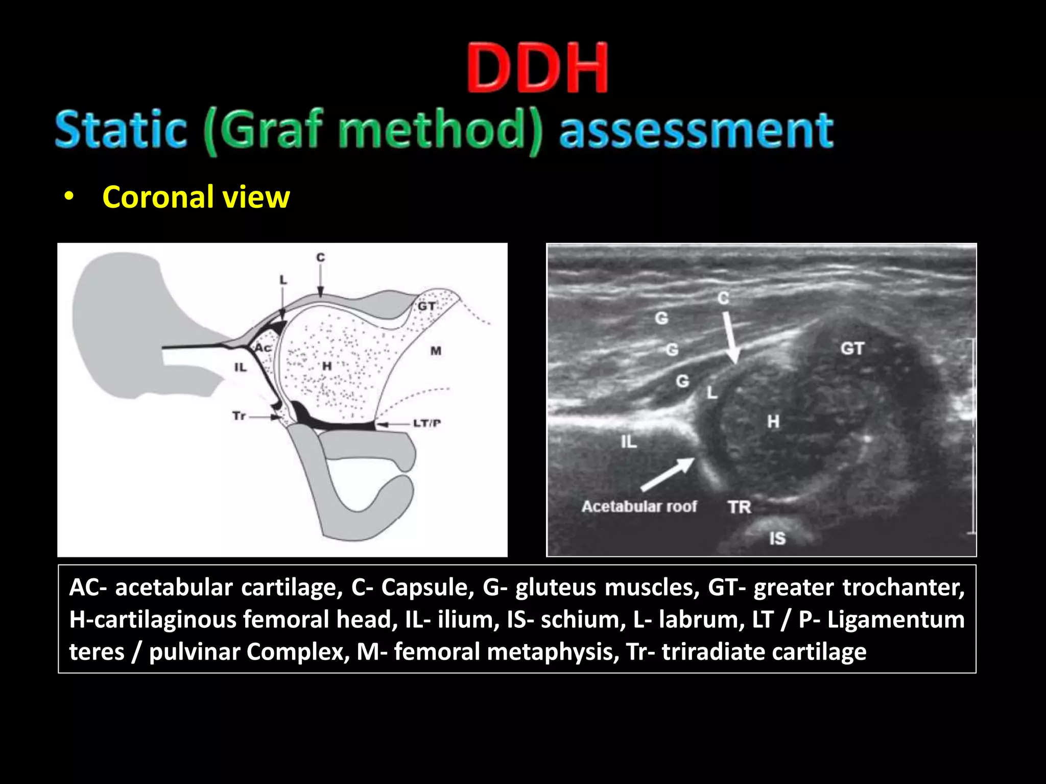 Developmental dysplasia of hip | PPTX