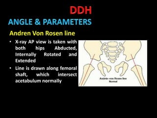 Developmental dysplasia of hip | PPT