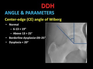 Developmental dysplasia of hip | PPT