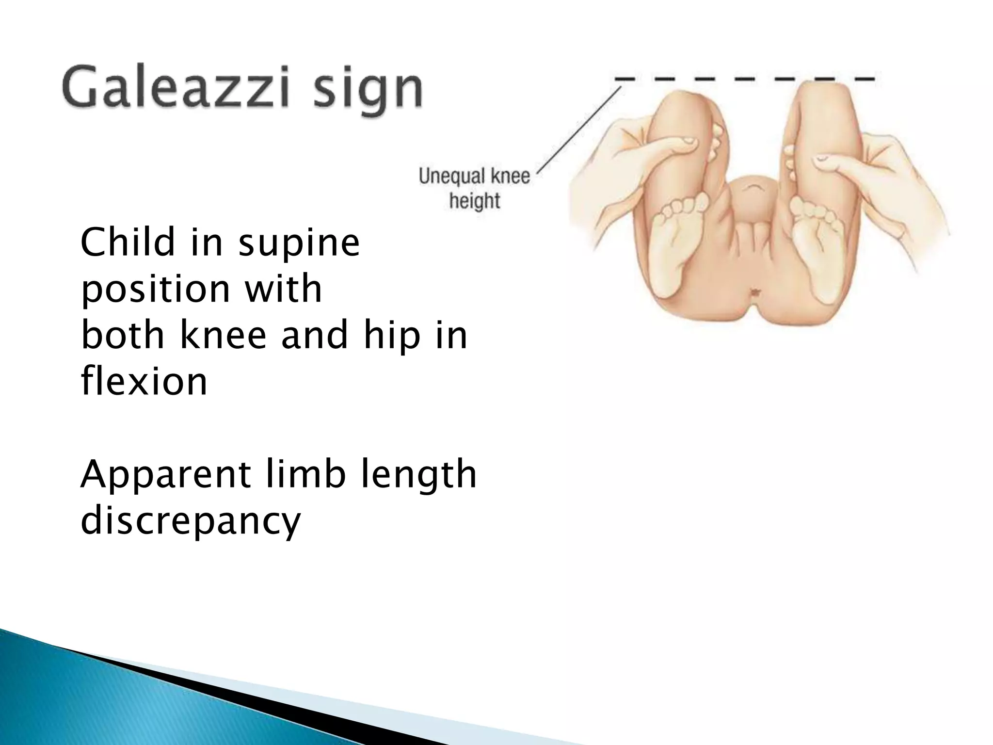 Developmental dysplasia of hip | PPTX