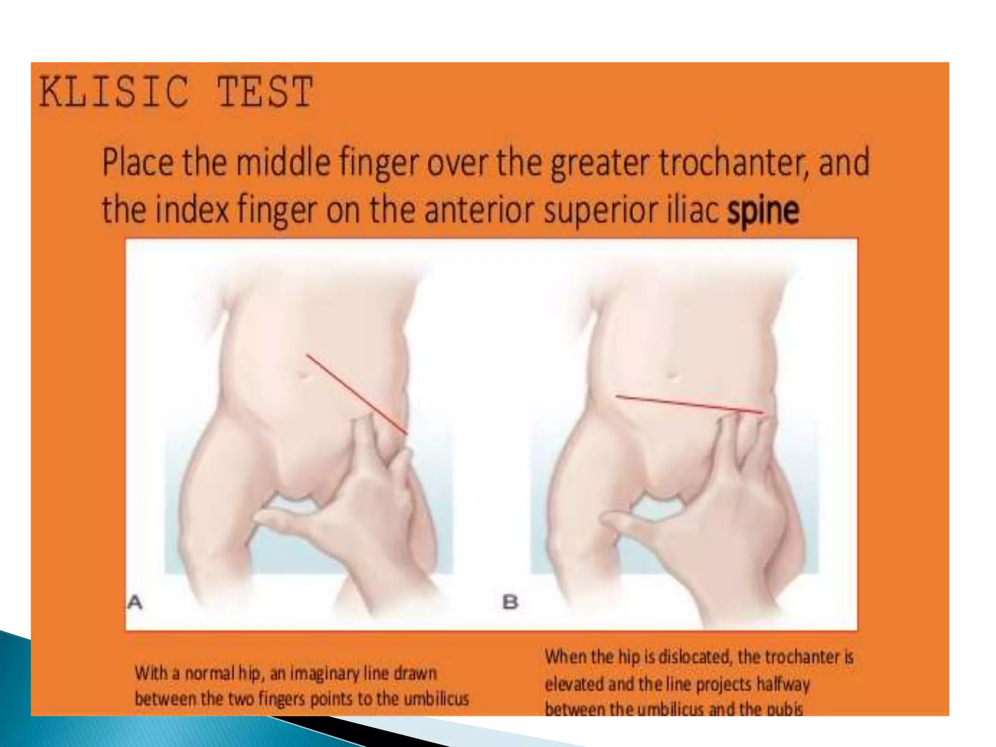 Developmental dysplasia of hip | PPTX