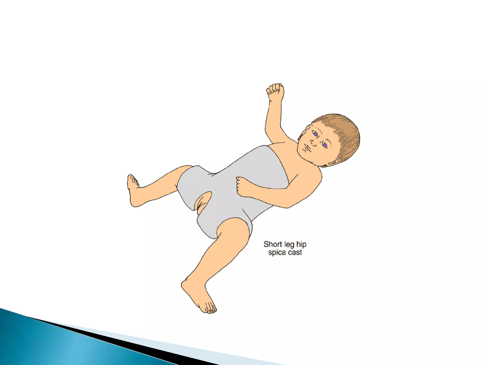 Developmental dysplasia of hip | PPTX