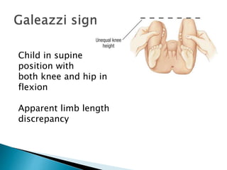 Developmental dysplasia of hip | PPTX
