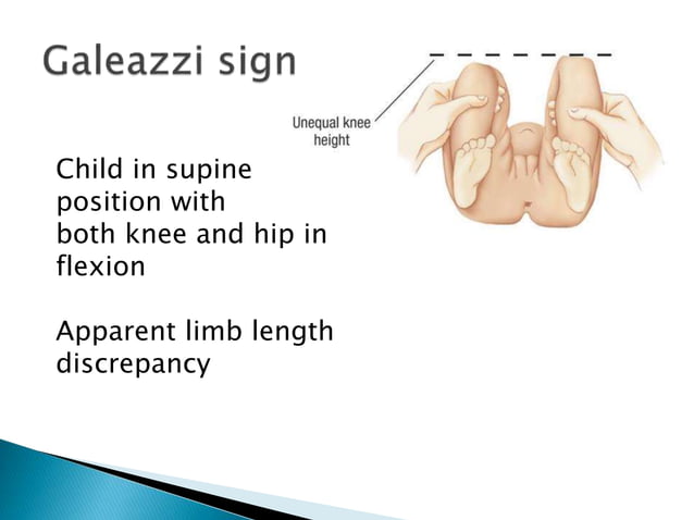 Developmental dysplasia of hip | PPTX