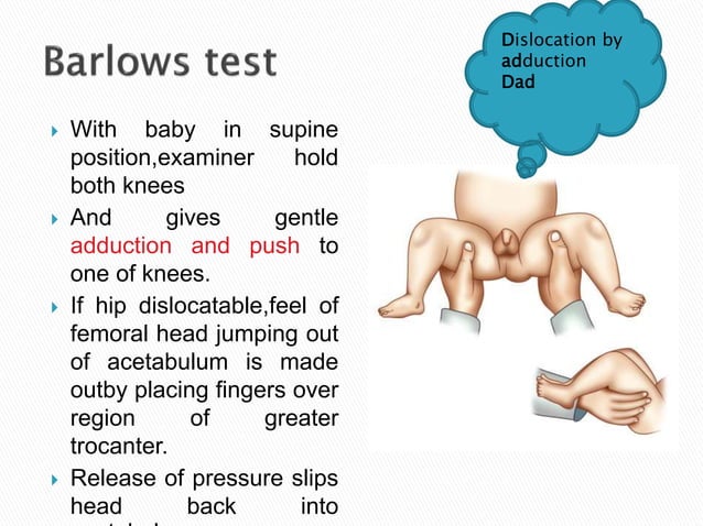 Developmental dysplasia of hip | PPTX