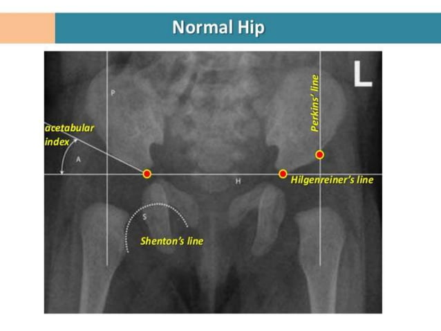 Developmental dysplasia of hip | PPTX