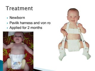 Developmental dysplasia of hip | PPTX