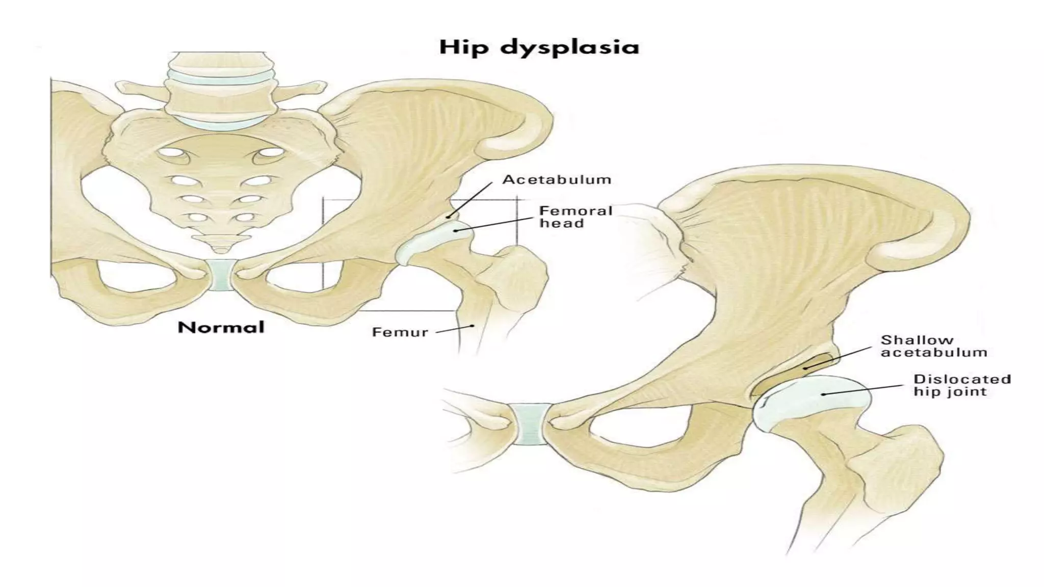 Developmental dysplasia of hip | PPTX
