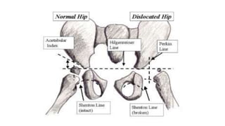 Developmental dysplasia of hip | PPTX