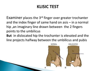 DEVELOPMENTAL DYSPLASIA OF HIP.pptx