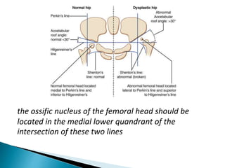 DEVELOPMENTAL DYSPLASIA OF HIP.pptx
