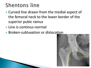 DEVELOPMENTAL DYSPLASIA OF HIP.pptx