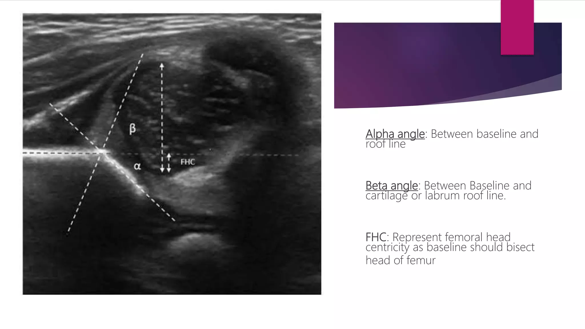 Developmental dysplasia of hip imaging | PPTX