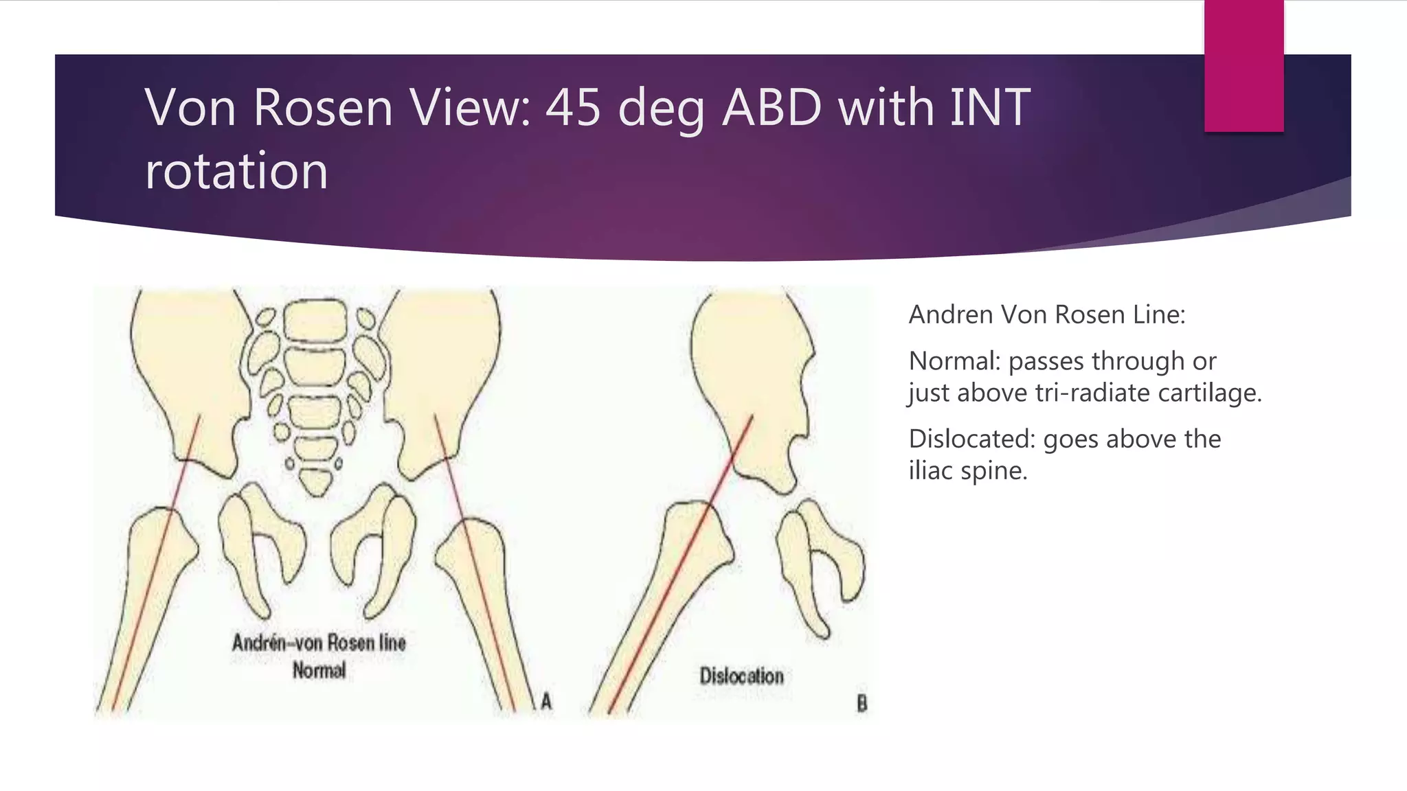Developmental dysplasia of hip imaging | PPTX