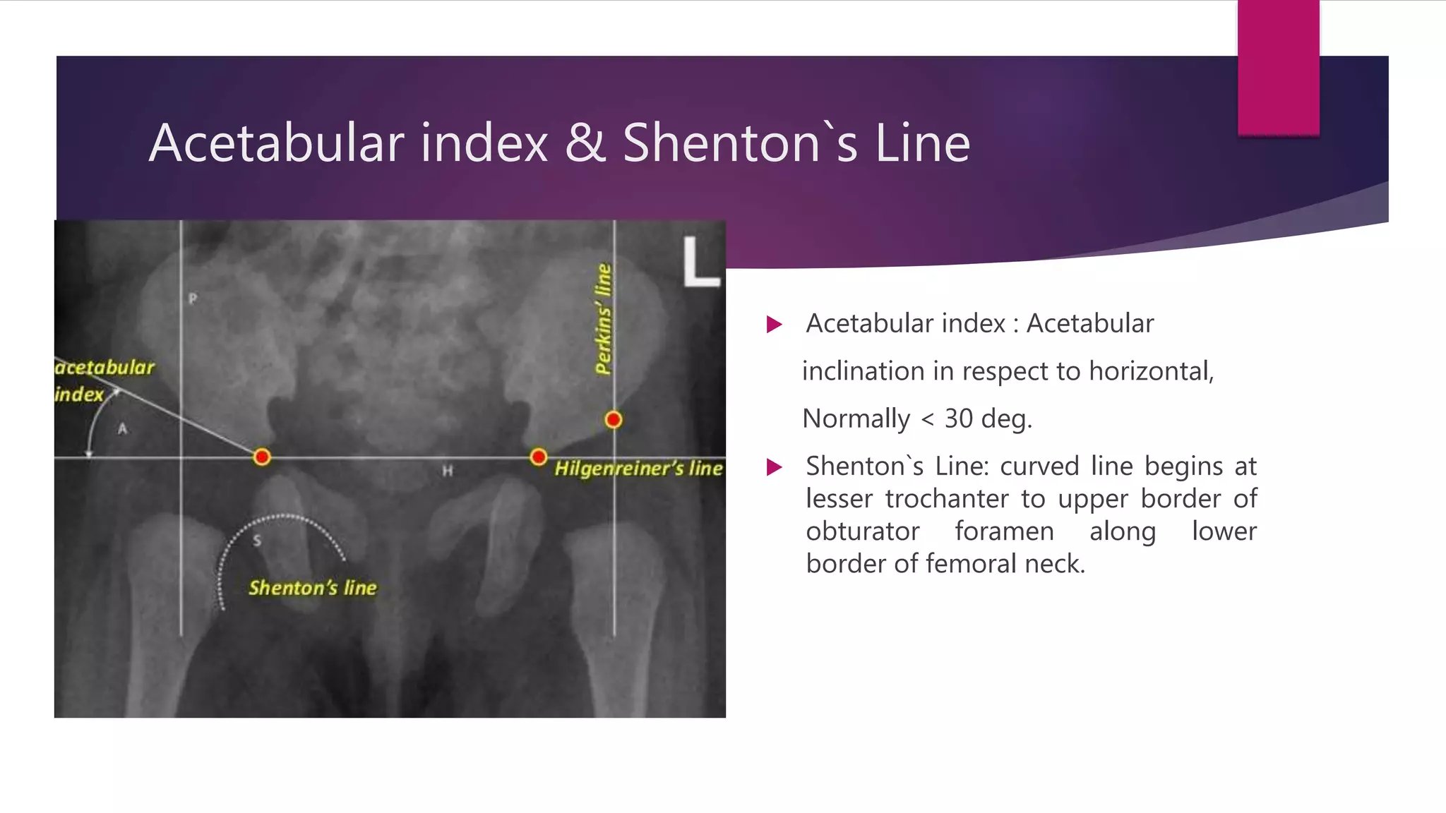 Developmental dysplasia of hip imaging | PPTX