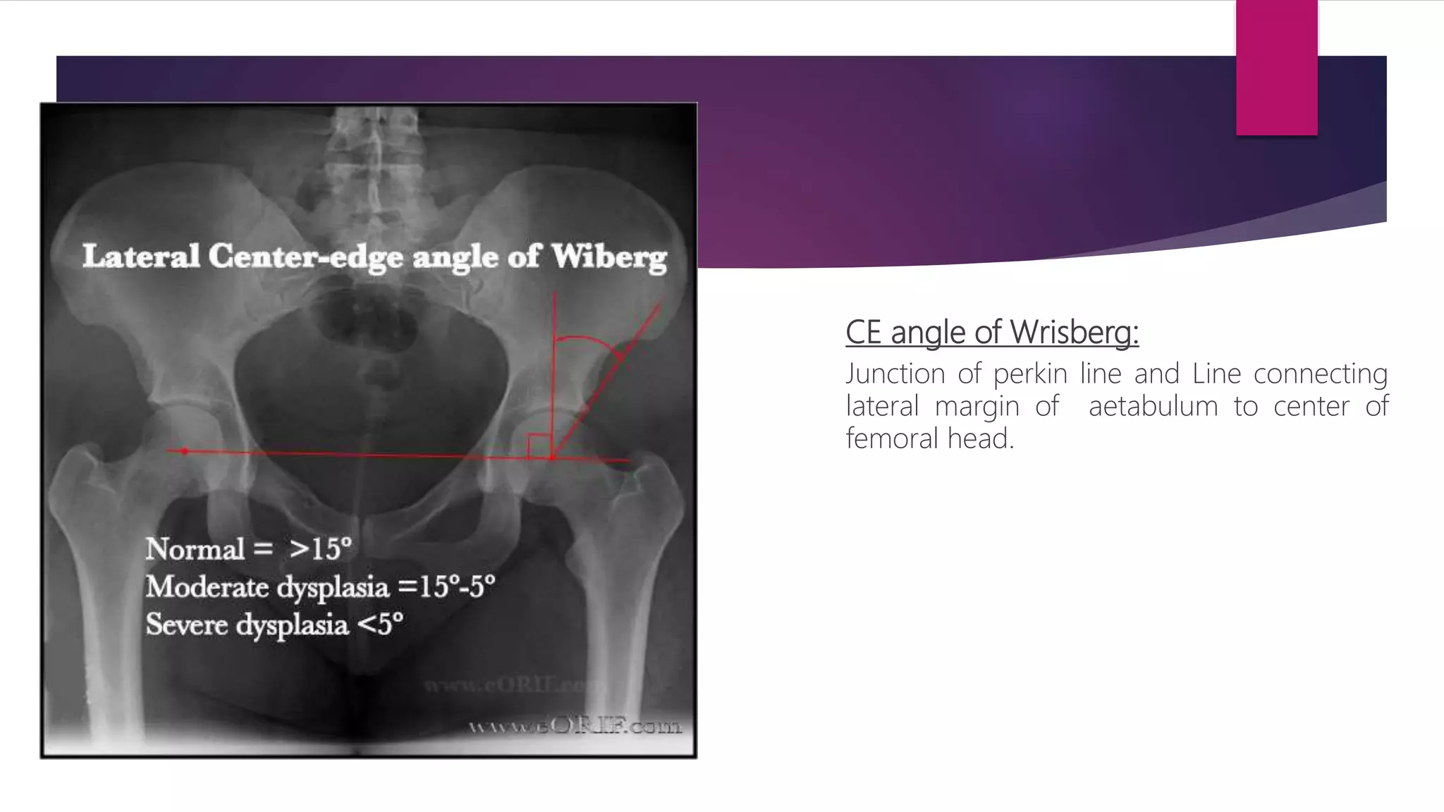 Developmental dysplasia of hip imaging | PPTX