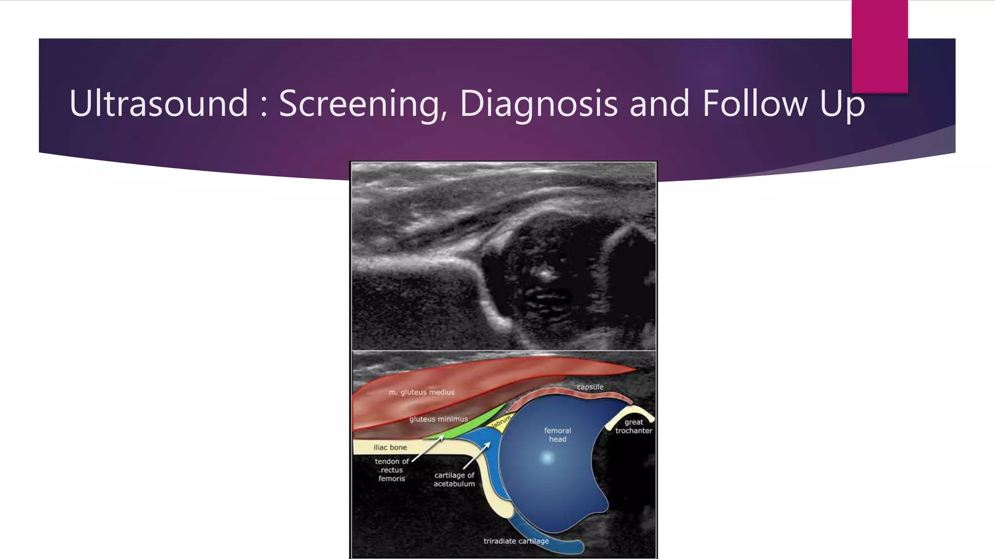 Developmental Dysplasia Of Hip Imaging Ppt