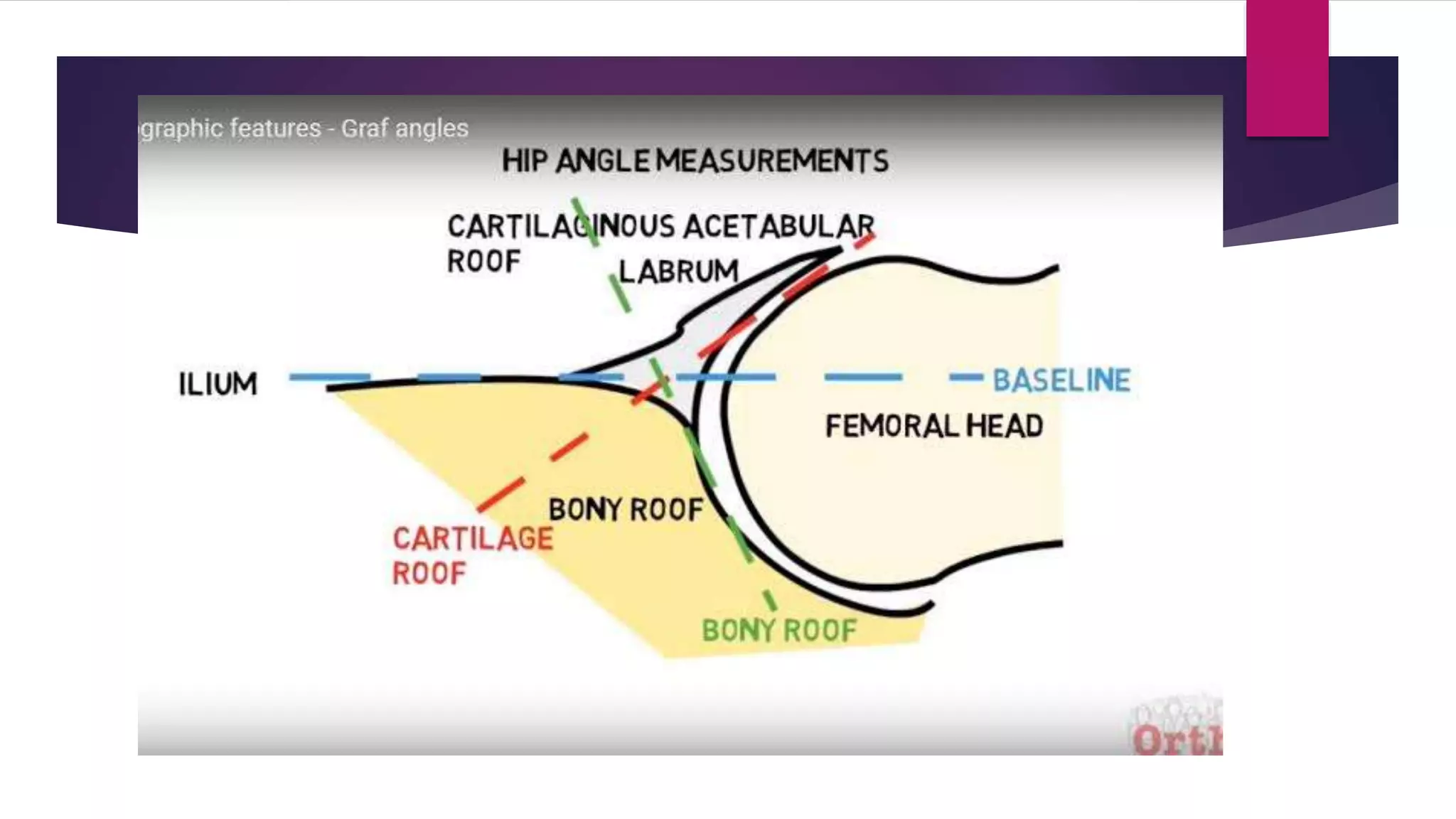 Developmental dysplasia of hip imaging | PPTX