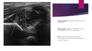 Developmental dysplasia of hip imaging | PPTX