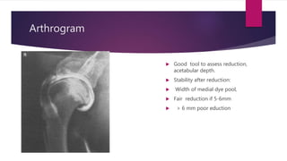 Developmental dysplasia of hip imaging | PPTX